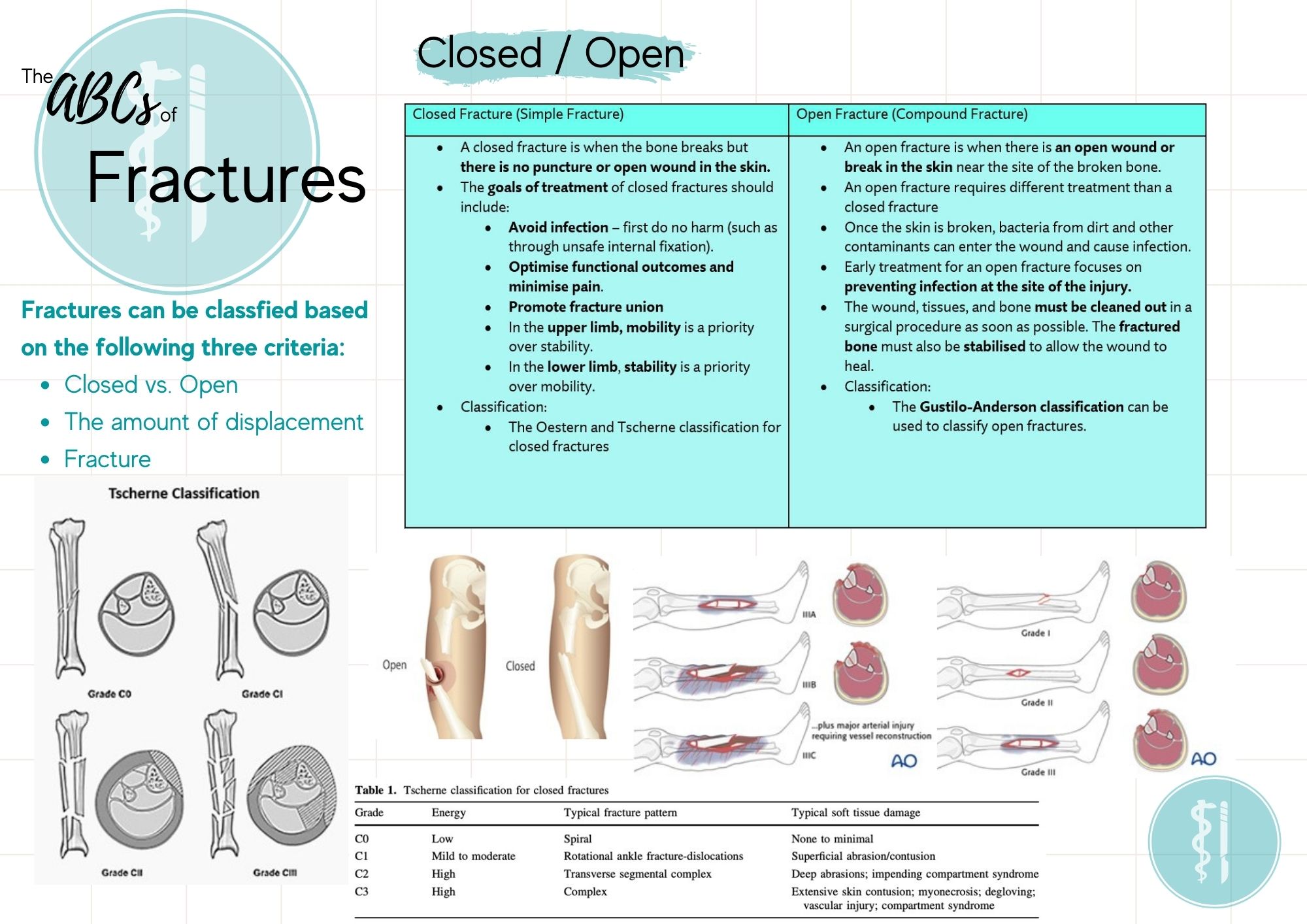 ABCs of: Fractures – Surgical Interest Group of Monash University Malaysia