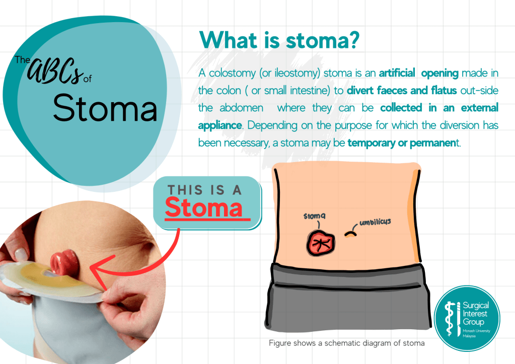 ABCs of: Stoma – Surgical Interest Group of Monash University Malaysia